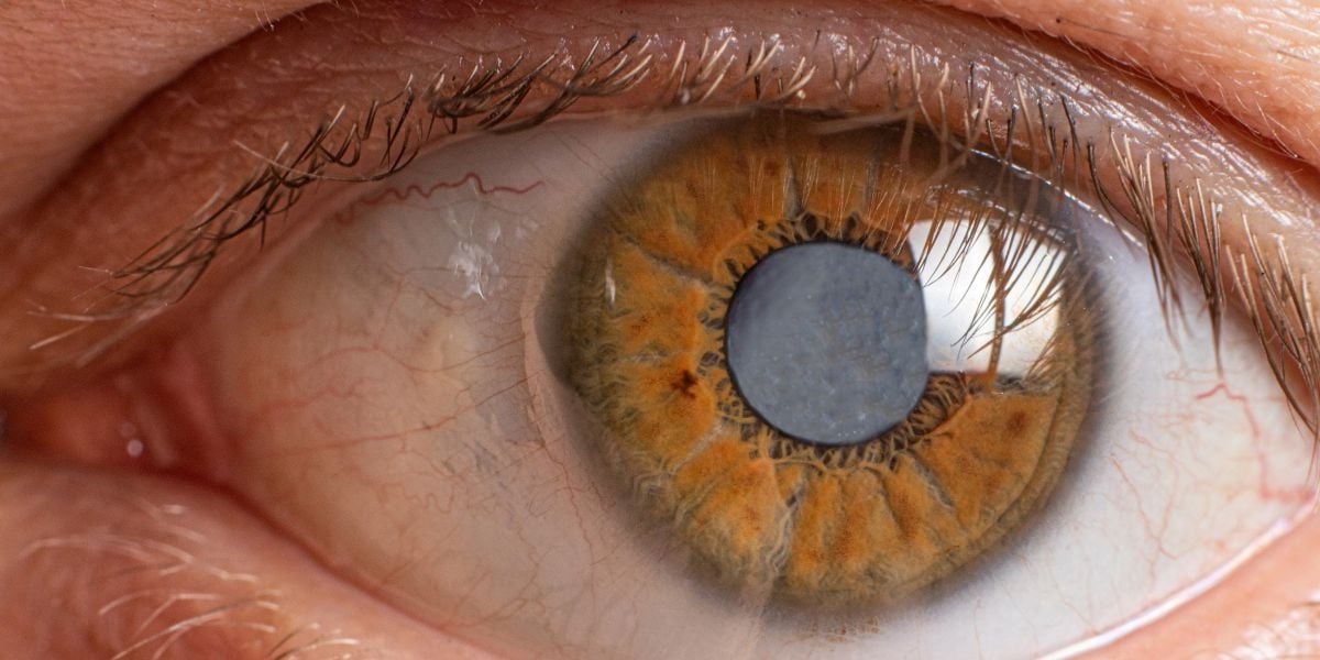 Glaucoma La Silenciosa Enfermedad Ocular Que Deteriora La Visión Para
